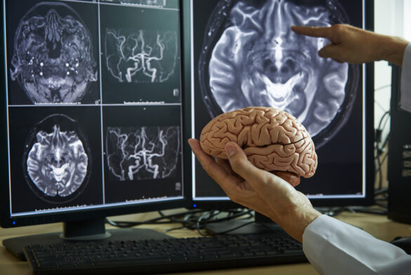 Z Mensa akademie: Minulost, současnost a budoucnost neurochirurgie ...